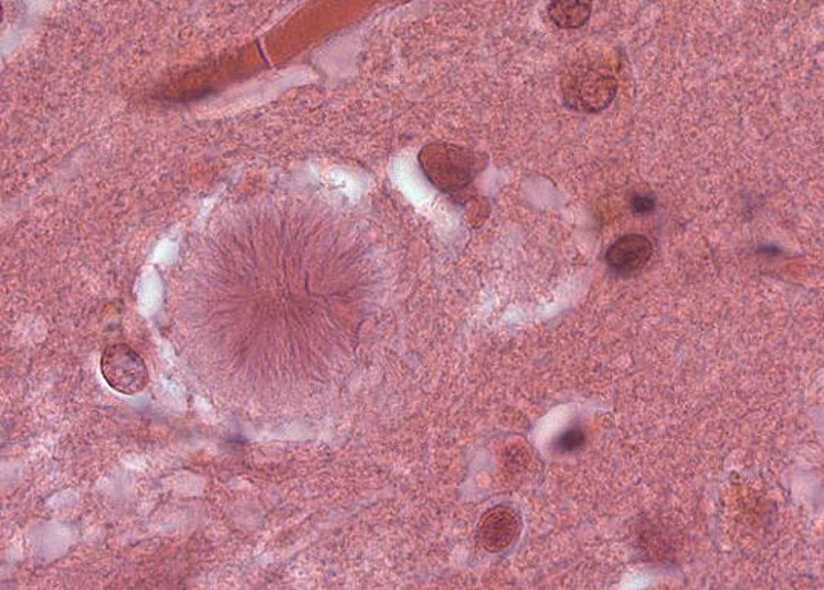 Prions, Nearly Indestructible and Universally Lethal, Seed the Eyes of ...