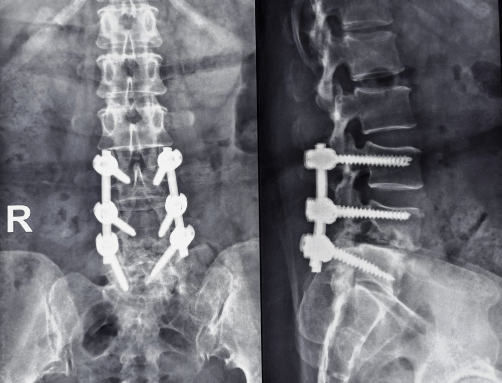 Luigi Mangione Said He Had Spondylolisthesis: What Is It? | Scientific ...