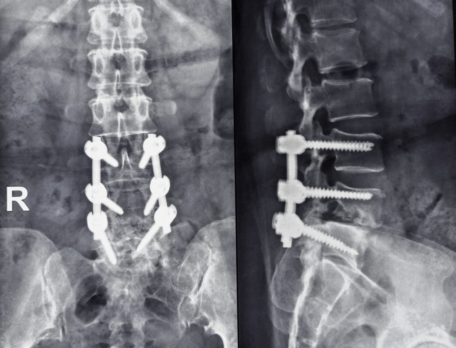 Luigi Mangione Said He Had Spondylolisthesis: What Is It? | Scientific ...