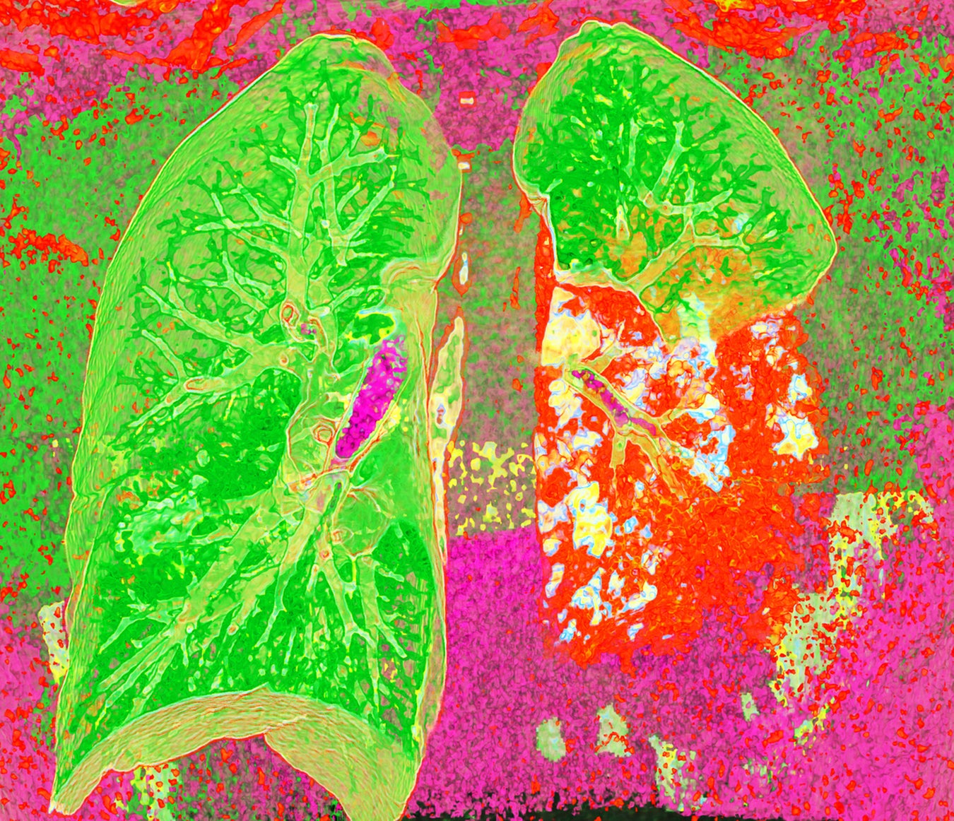New Pneumonia Vaccine Guidelines Could Save More People from Deadly ...
