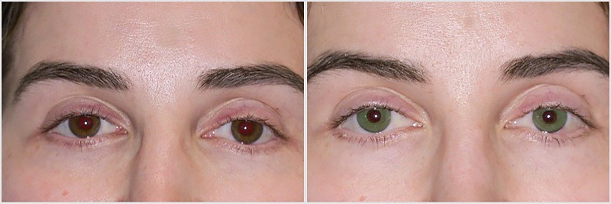 Surgeons Can Permanently Change Eye Color with Experimental ...