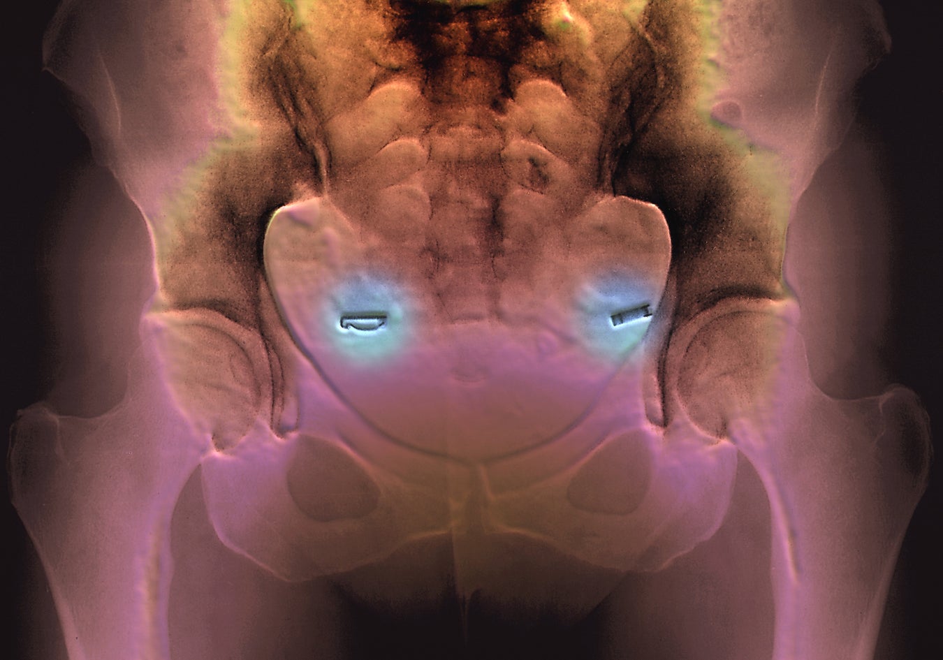 More Men Are Getting Vasectomies Since Roe Was Overturned | Scientific ...