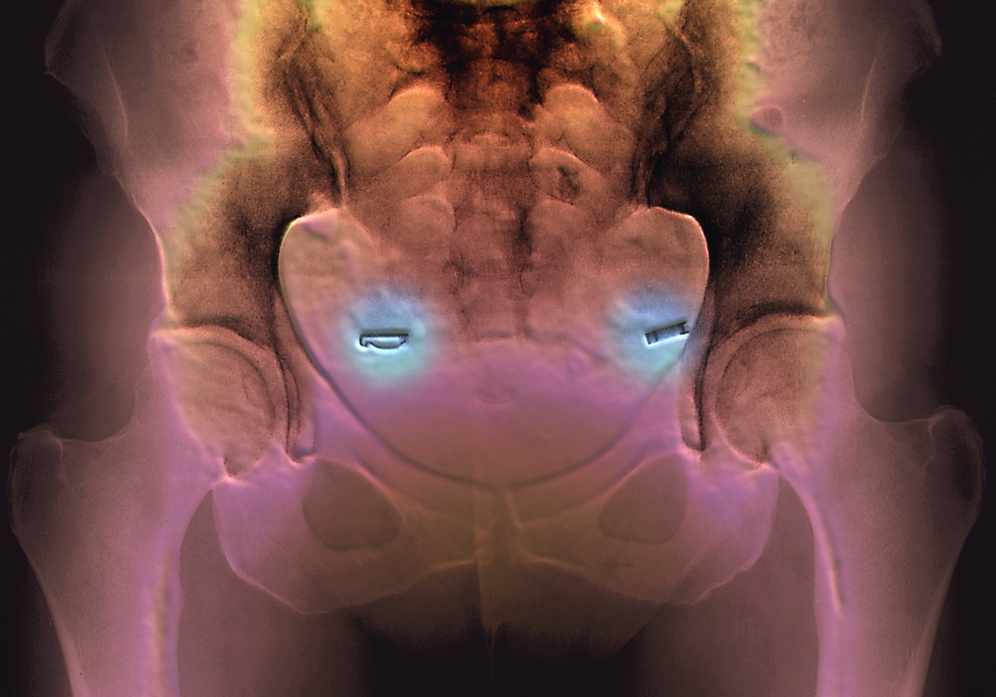 More Men Are Getting Vasectomies Since Roe Was Overturned | Scientific ...