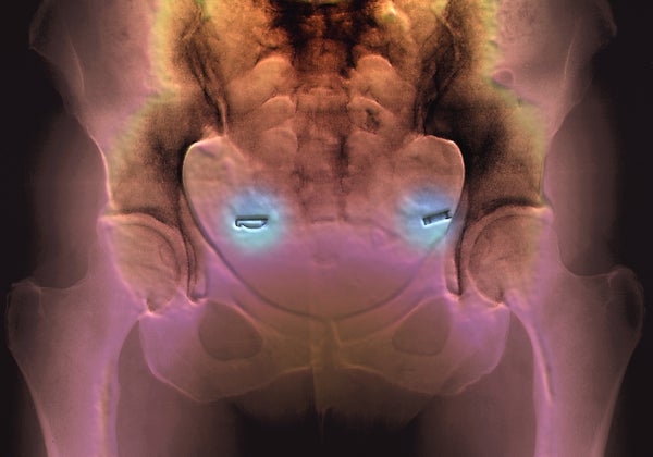 More Men Are Getting Vasectomies Since Roe Was Overturned | Scientific ...