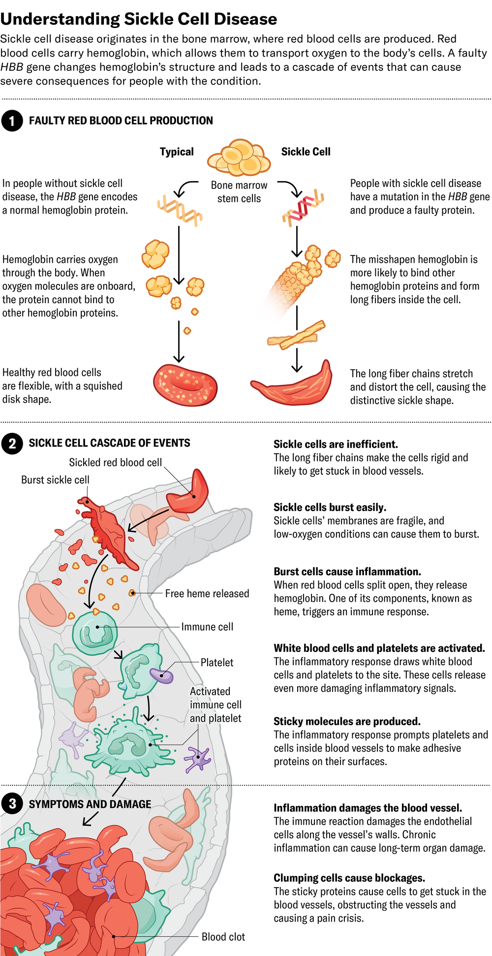 New Sickle Cell Treatments Reach Patients after Years of Effort ...