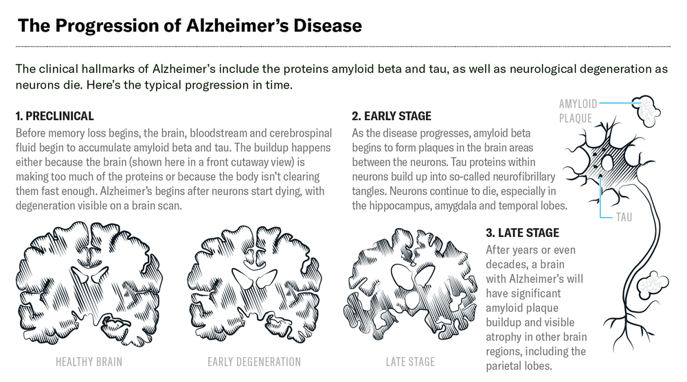Alzheimer’s Impact on the Brain | Scientific American