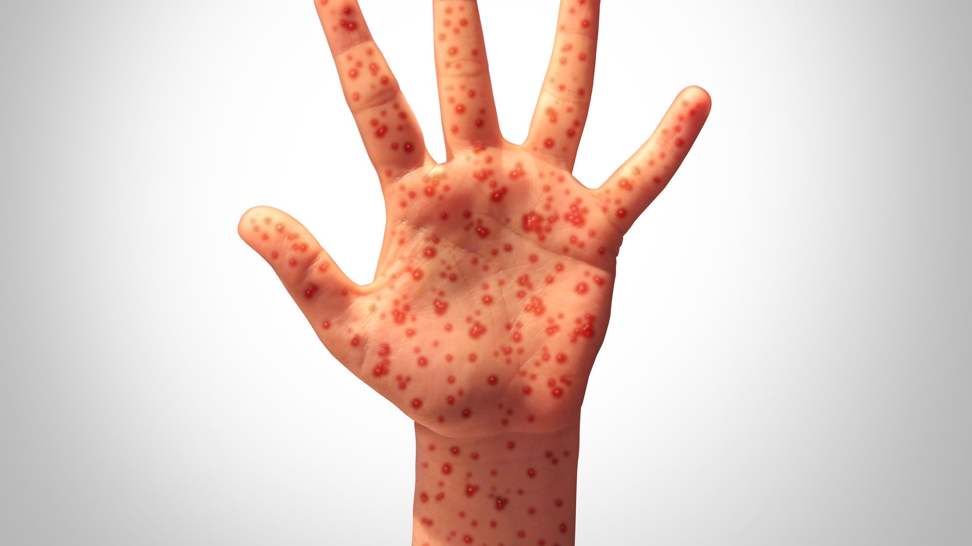 measles treatment medicine