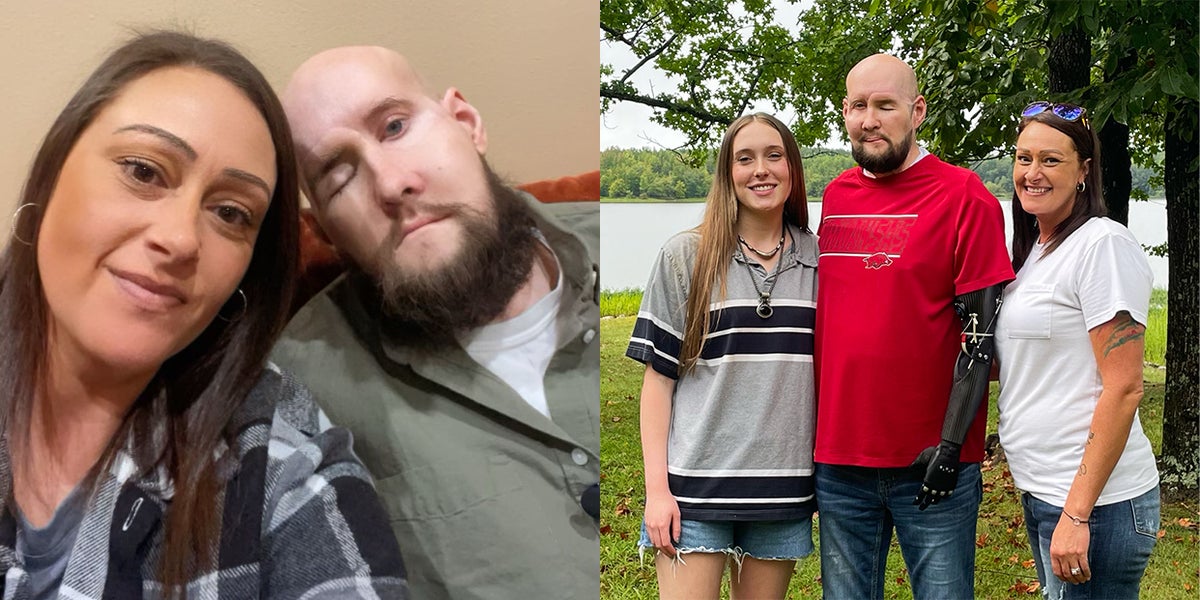 The First Person to Receive an Eye and Face Transplant Is Recovering ...