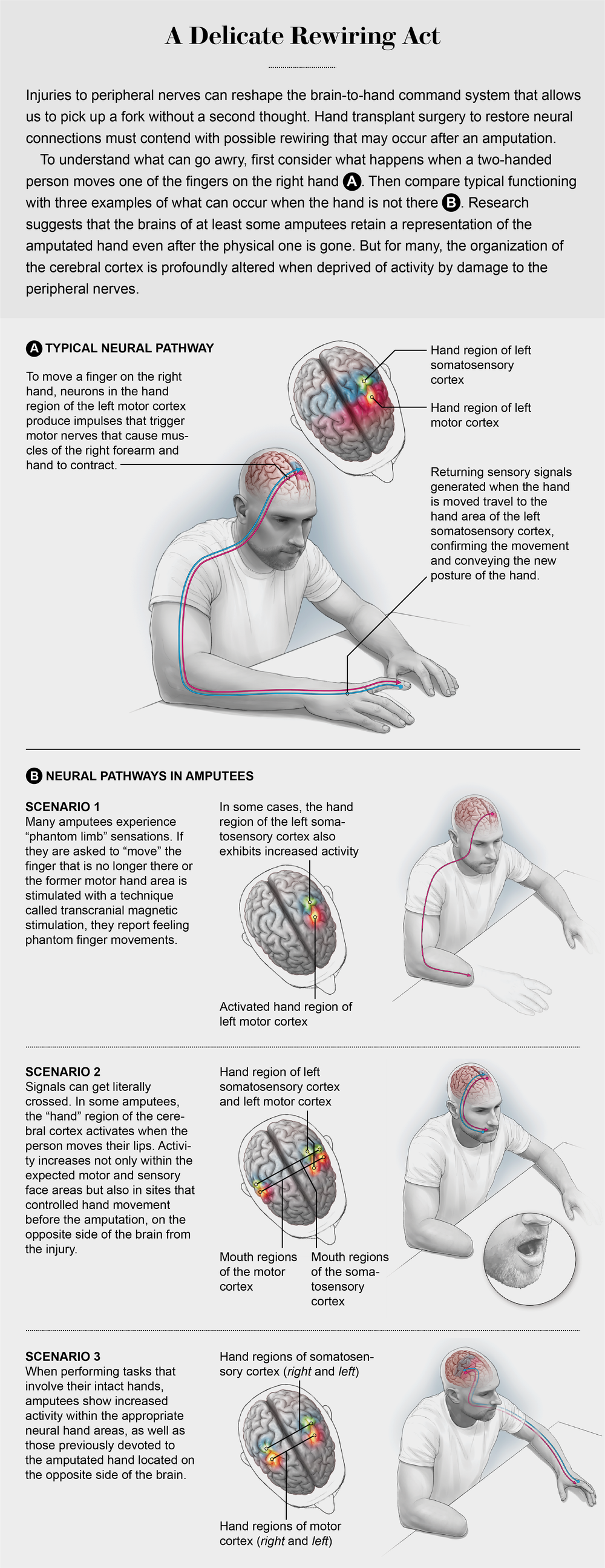 Hand Transplants Demonstrate the Nervous System's Amazing Adaptability ...