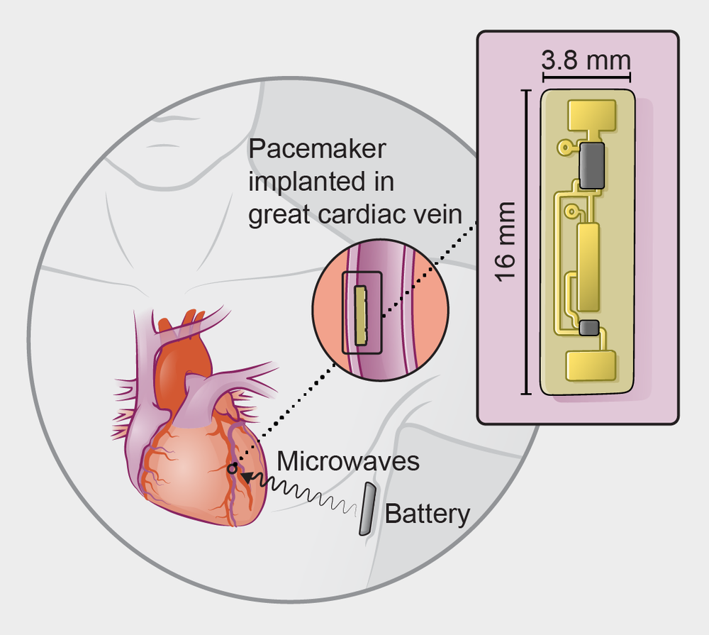 New Wireless Pacemaker Could Prevent Common Complications | Scientific ...