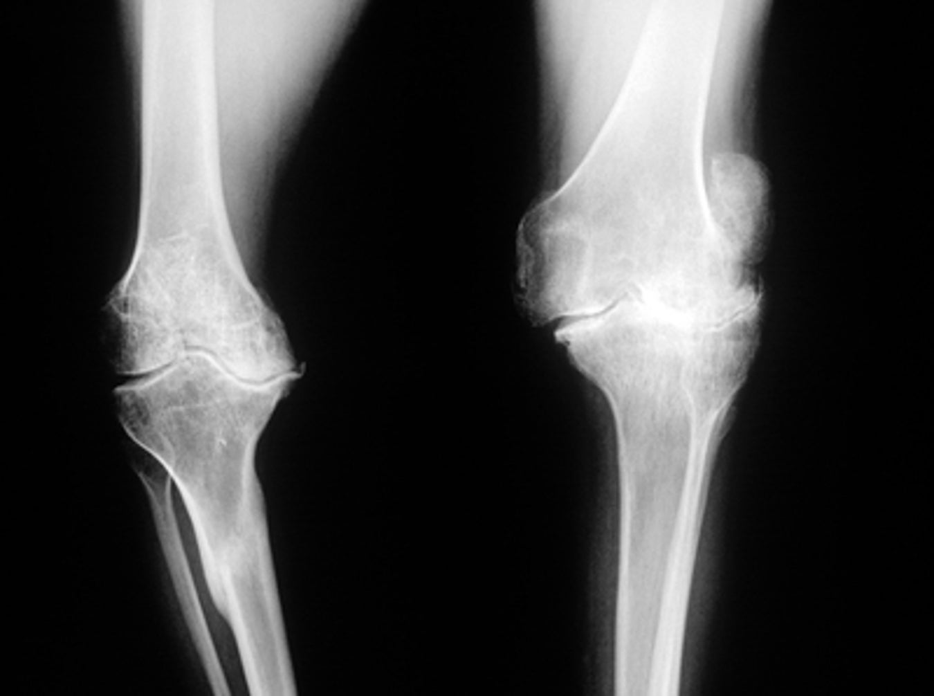 Haemophilia's Crippling Joint Pain Is a Target for Scientists ...
