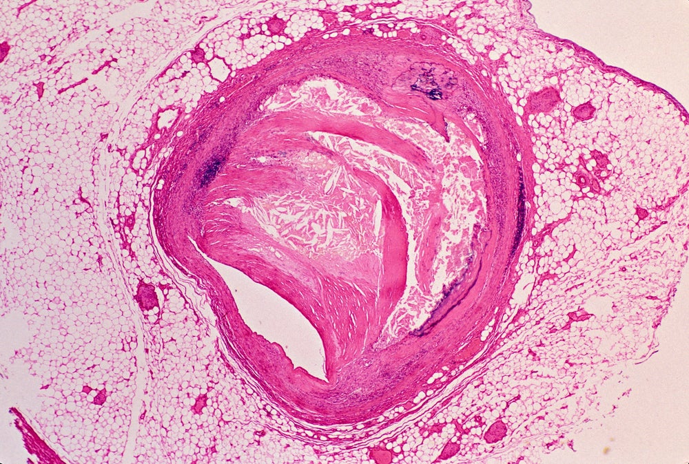 Inflammation in Heart Disease: Do Researchers Know Enough? | Scientific ...