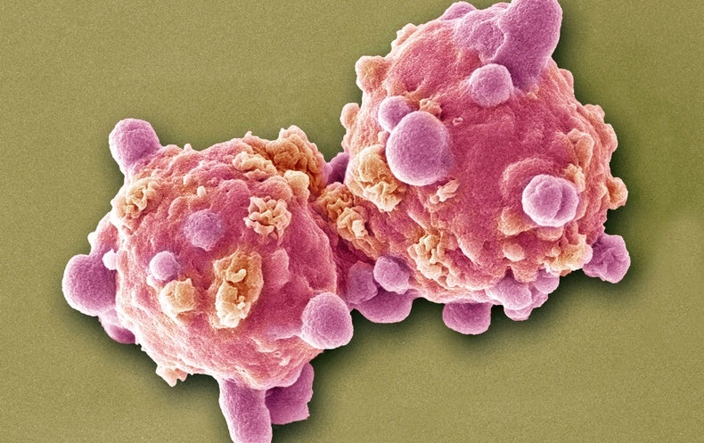 Powerful Childhood Cancer Treatment Holds Promise--and Poses Hazards ...