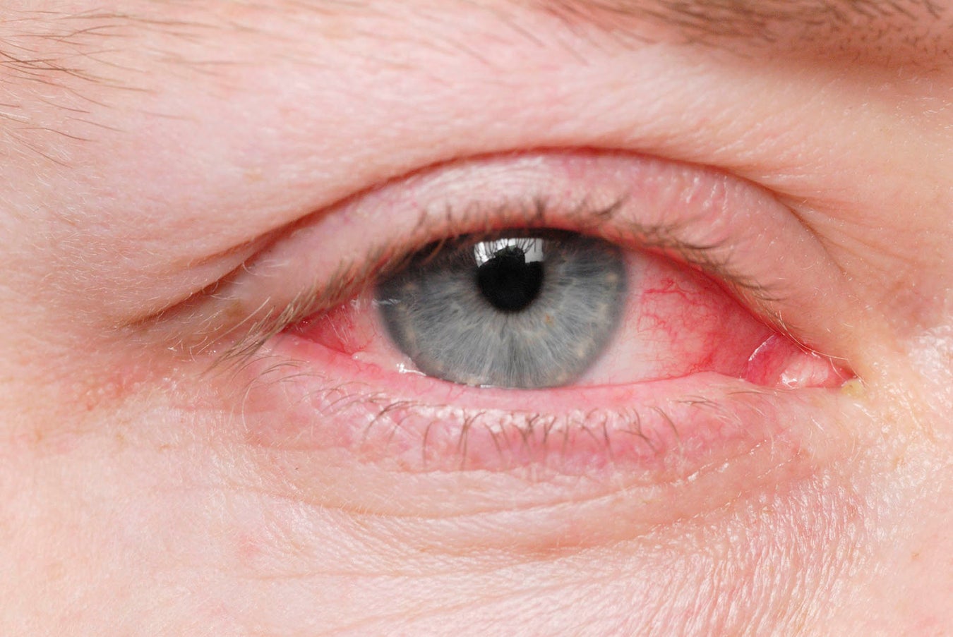 What Is Causing So Much Pink Eye? | Scientific American