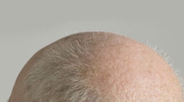 Treating Baldness is "Not Like Growing Grass" - Scientific American