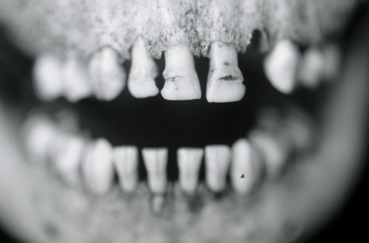 Ancient Tooth Tartar Traps Clues to Iron Age Diet | Scientific American