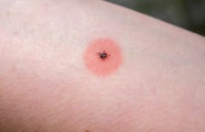 Types Of Tick Bites Types Of Tick Bites