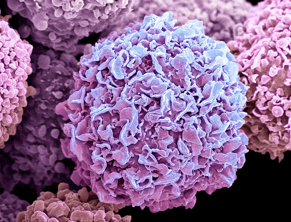 Taking Early Cancer Detection to the Next Level | Scientific American