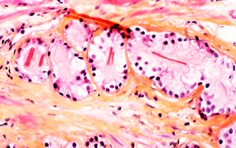 "Rapid Autopsy" Programs Seek Clues to Cancer within Hours of Death ...