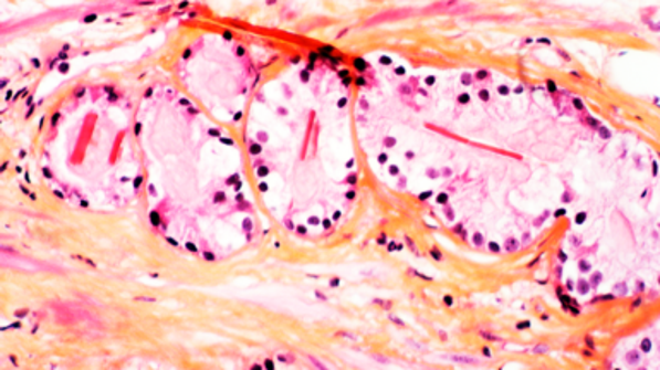"Rapid Autopsy" Programs Seek Clues to Cancer within Hours of Death ...