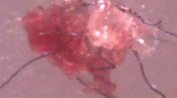 What is Morgellons Disease? Is it a physical or psychological condition ...