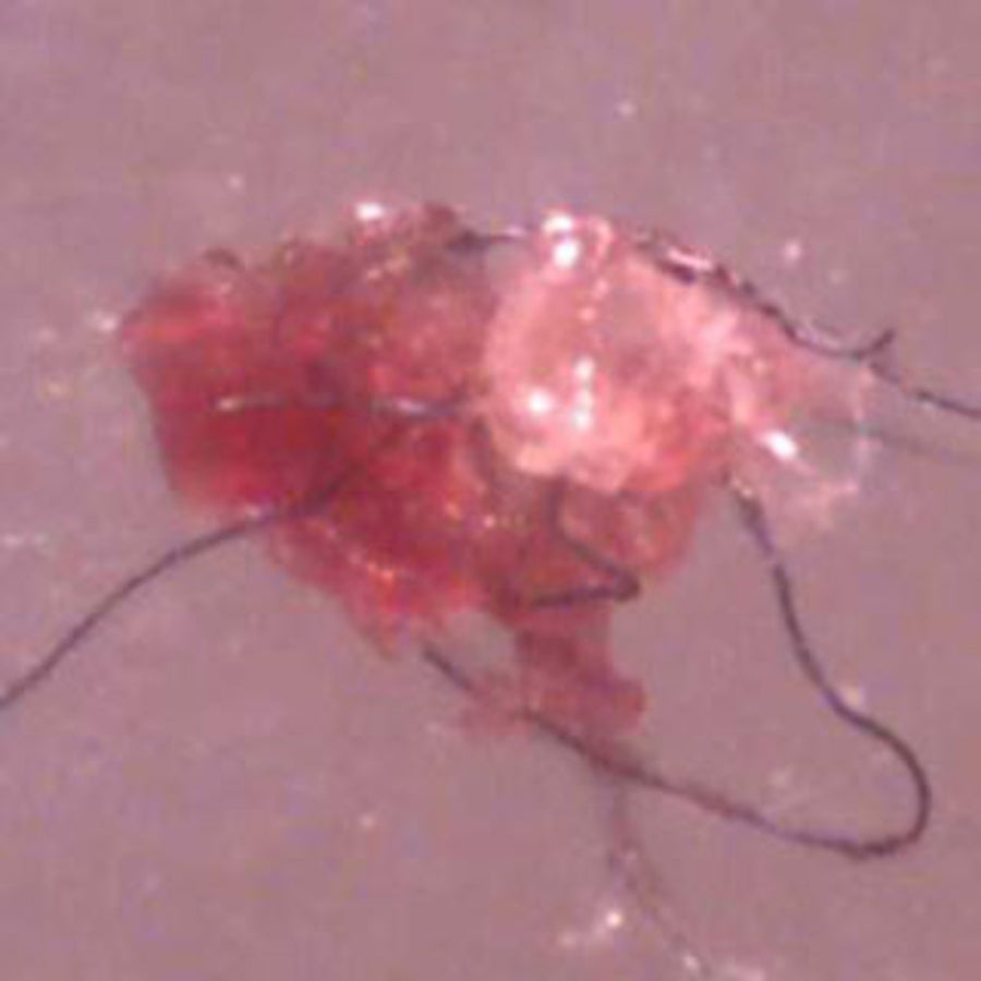 What is Morgellons Disease? Is it a physical or psychological condition ...