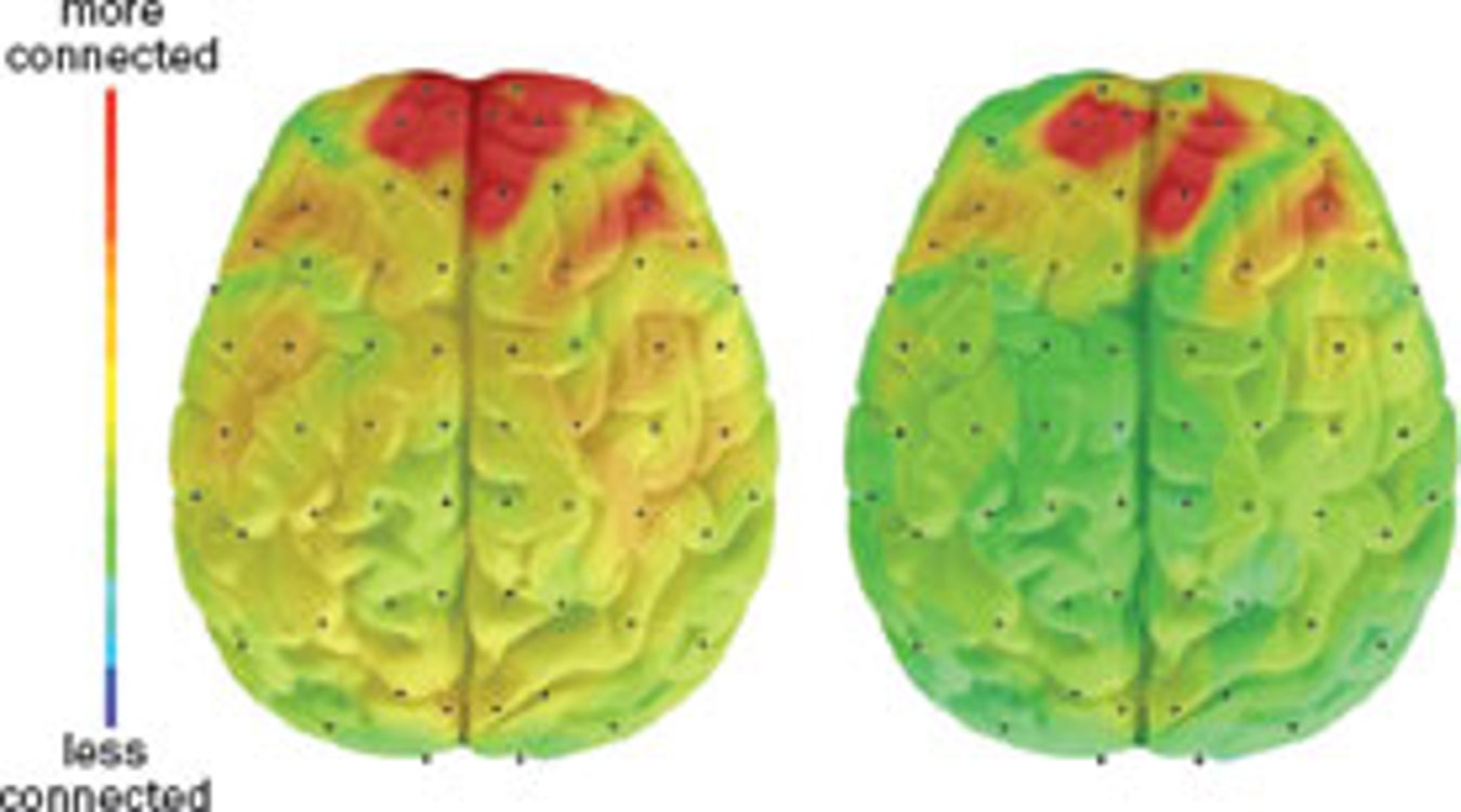 Depression Linked with Hyperconnected Brain Areas | Scientific American