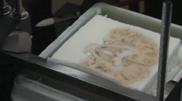 Postmortem of Famous Patient's Brain Explains Why "H. M." Couldn't ...