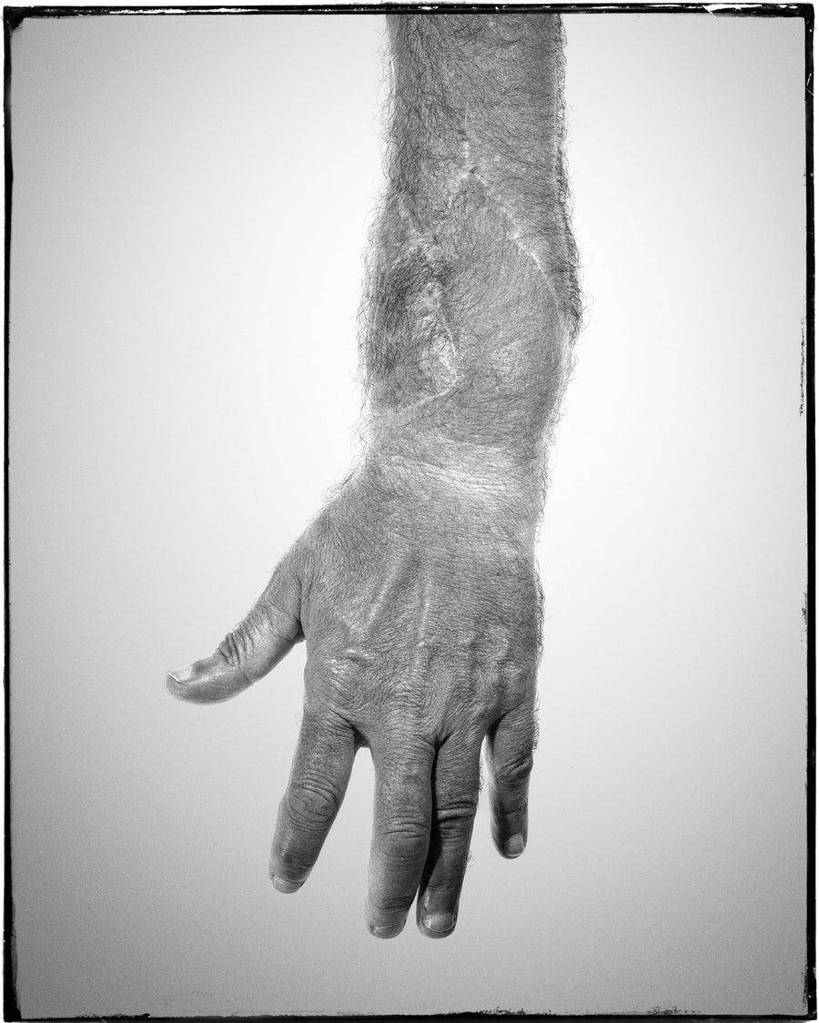 Hand Transplants Demonstrate the Nervous System's Amazing Adaptability ...