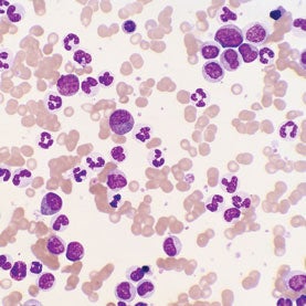 How Do Tumors Grow? - Scientific American