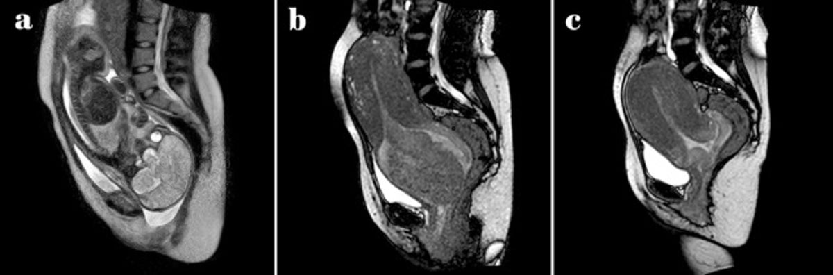 Womb with a View: Labor inside an MRI Scanner Reveals the Mechanics of ...