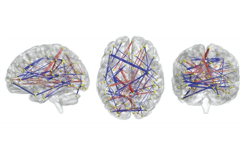 Eeg Brain Scans May Detect Signs Of Autism In 2yearolds