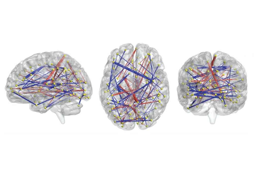 Brain Scans May Forecast Autism in Babies | Scientific American