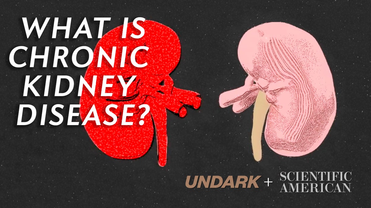 What Is Chronic Kidney Disease, and How Might It Affect You ...