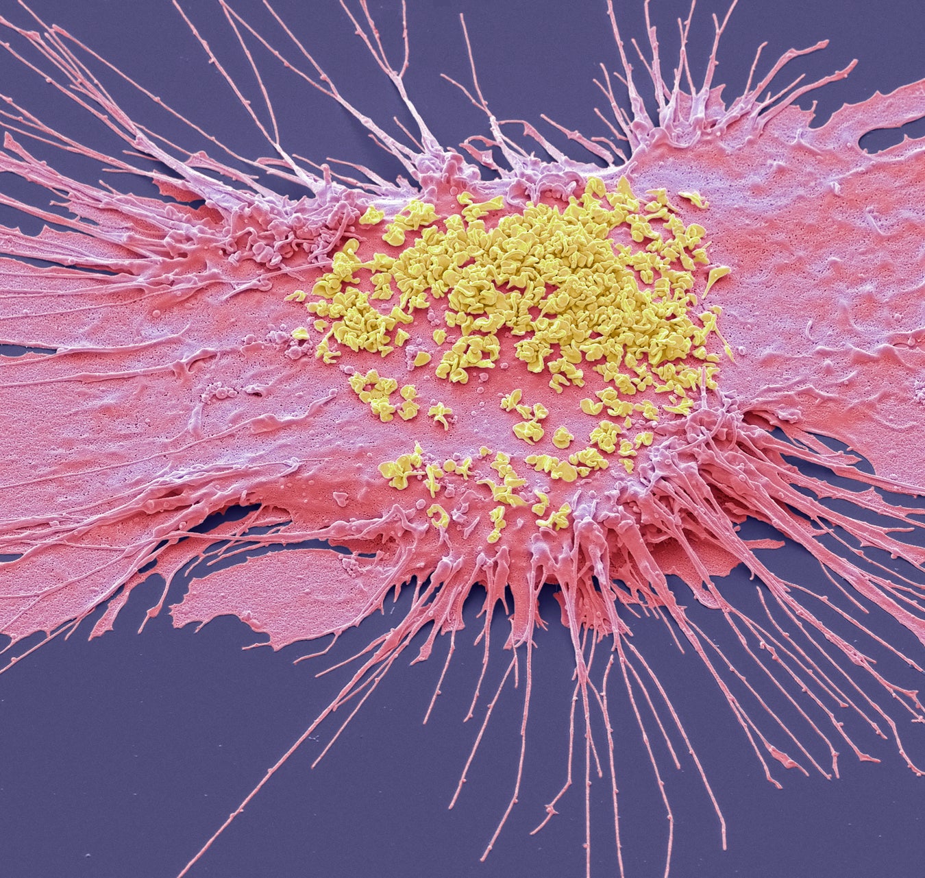 The Real Story Behind 'White Lung Pneumonia' | Scientific American