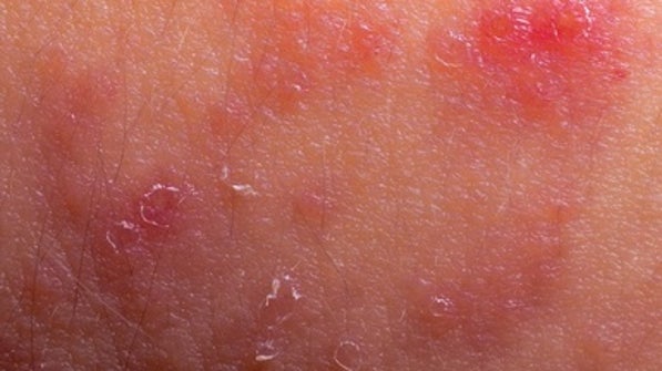 Bacteria Might Share the Blame for Eczema - Scientific American