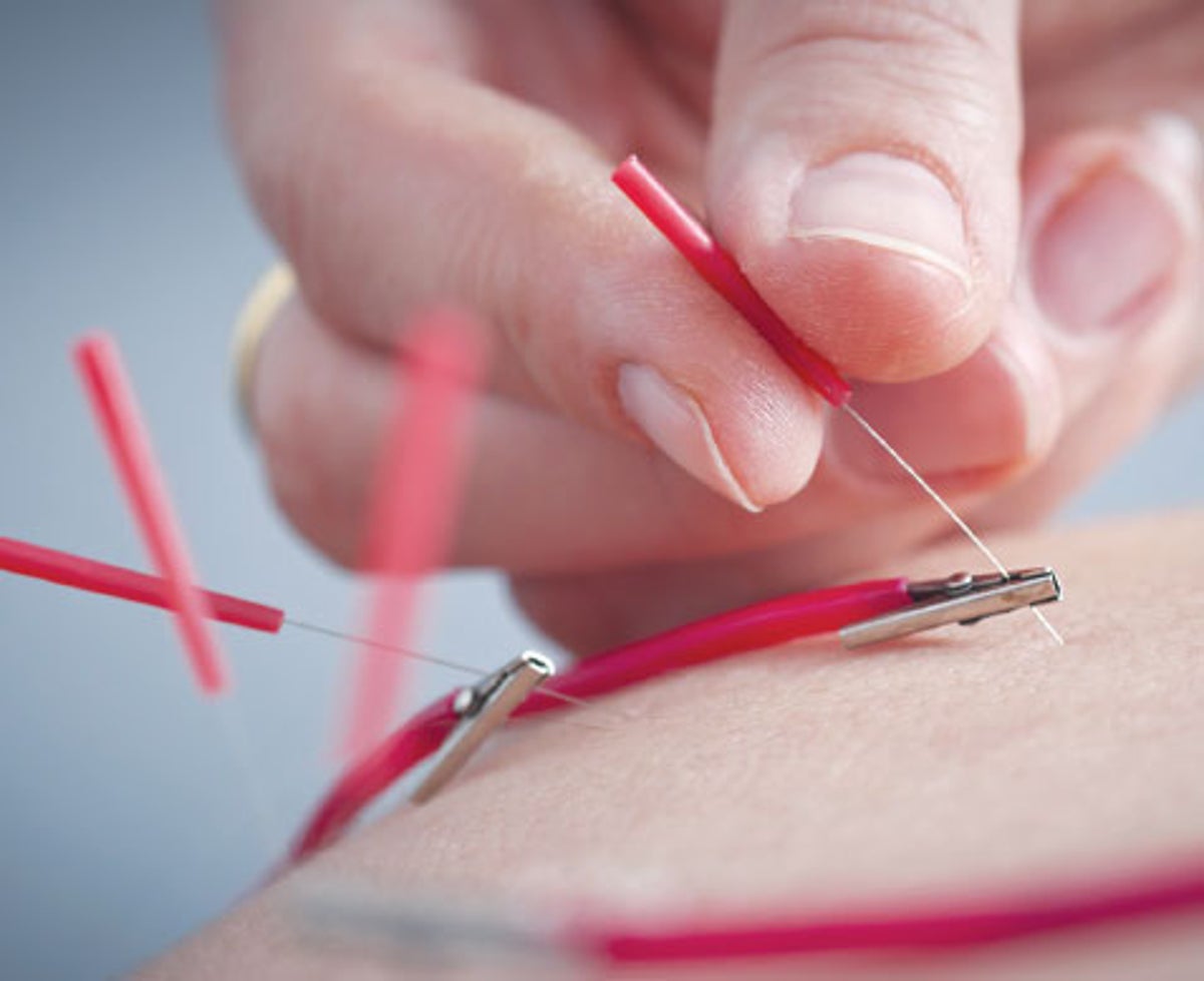 Can Acupuncture Curb Killer Immune Reactions? | Scientific American