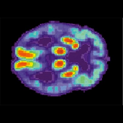 Do Brain Scans of Comatose Patients Reveal a Conscious State ...