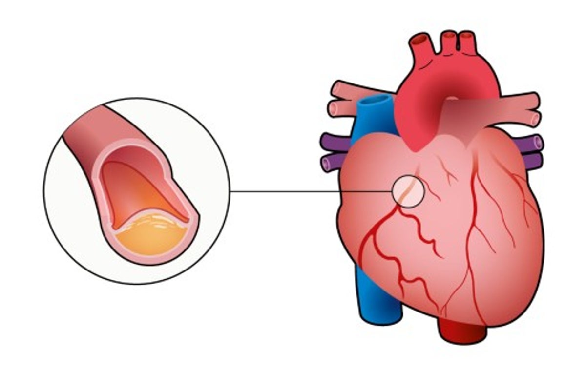 A Graphical Guide to Ischemic Heart Disease | Scientific American