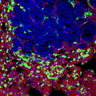 Tumor Time Bombs Set Off by Stem Cells - Scientific American