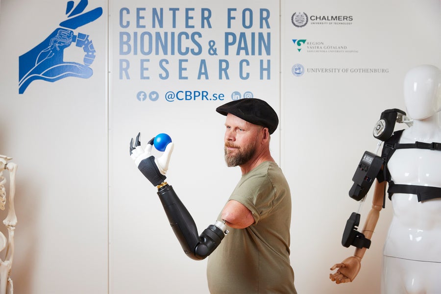 Above-Elbow Bionic Arm Can Control Every Finger | Scientific American